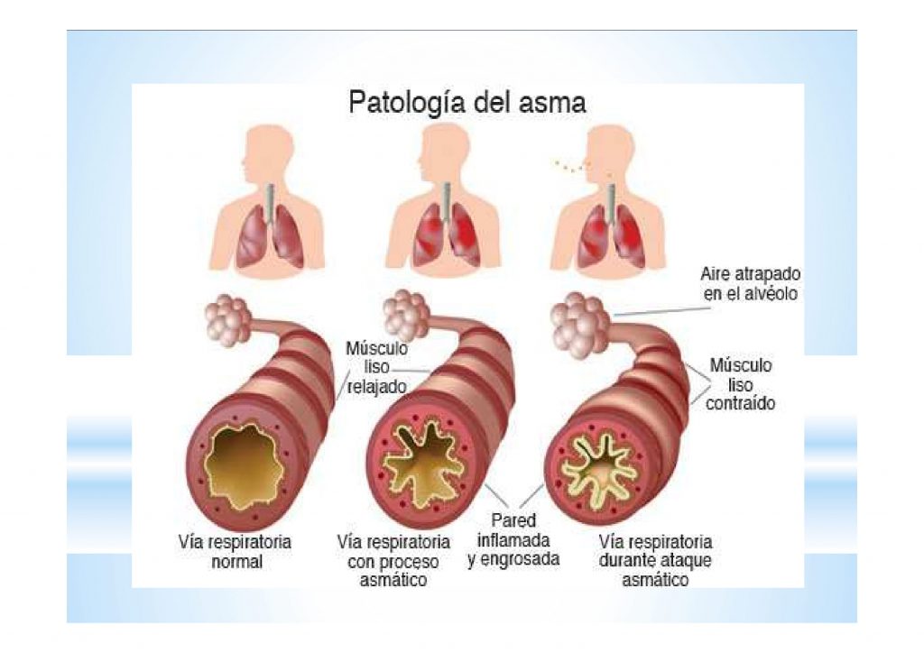 Alergias y Asma – Mas Vida